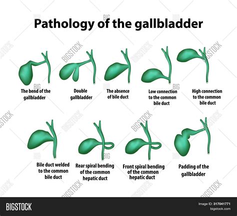 Pathology Gallbladder Image And Photo Free Trial Bigstock