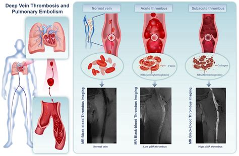 Association Between Thrombus Signal Intensity And Pulmonary Embolism In