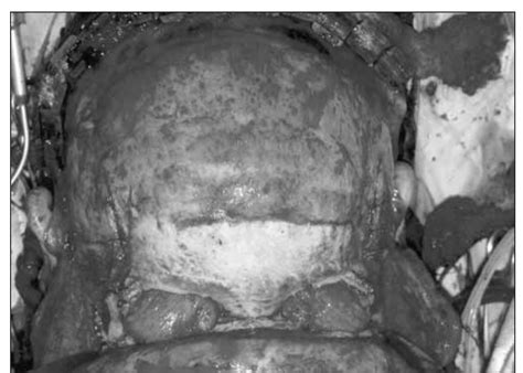 Coronal Exposure Showing Bilateral Orbitozygomatic