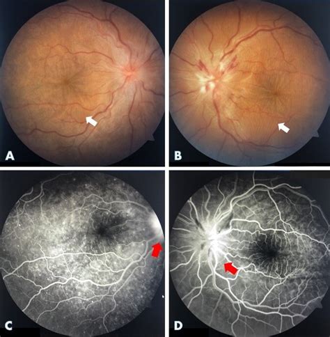 A Fundus Photograph Of The Right Eye Showing Optic Disc Edema 360° Download Scientific