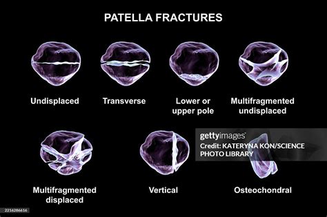 Classification Of Patella Fractures Illustration High Res Vector
