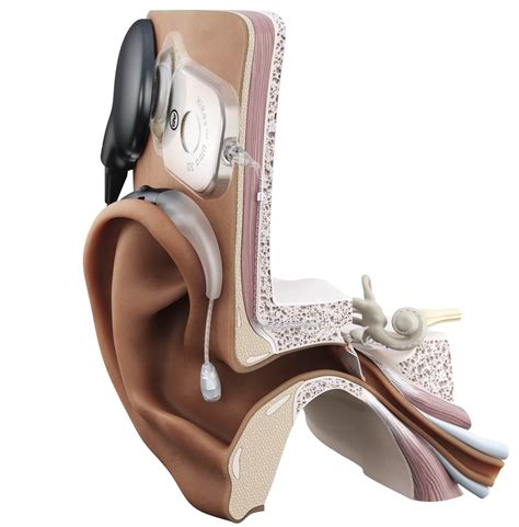 Understanding The Cochlear Implant Process From Evaluation To Candidacy Advanced Bionics