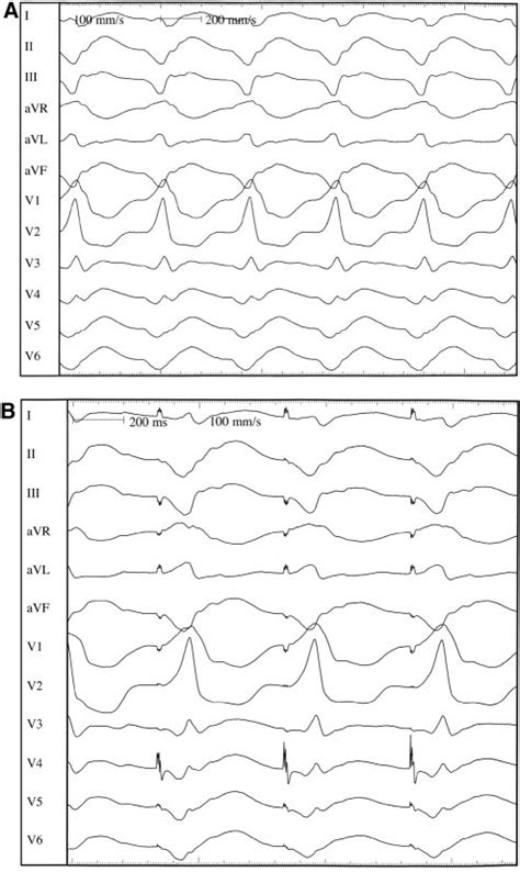 A Surface 12 Lead Ecg Of Normal Heart Vt B Epicardial Pace Map At