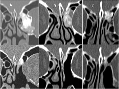 Ac Ct Of Patients With Osteomas With Spongious Component At The Og