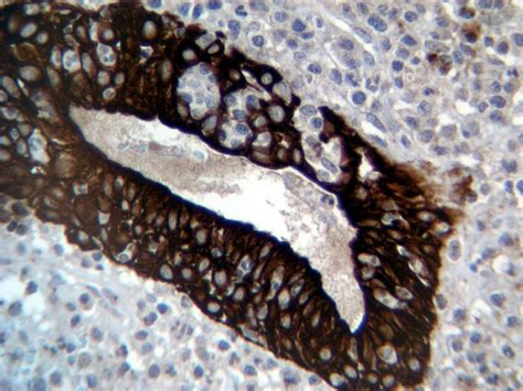 Monomorphic Neoplastic Lymphoid Cells With Hyperchromatic Nuclei