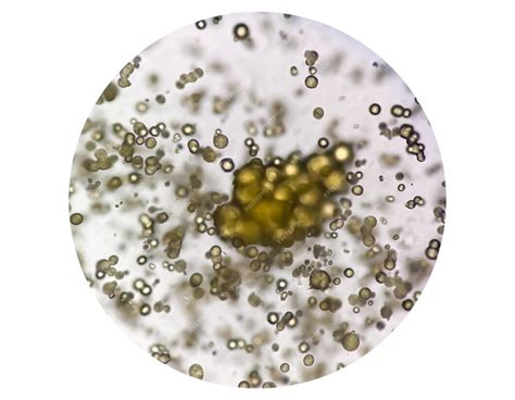 Imagen Microscópica De Análisis De Orina Examen De Orina Anormal