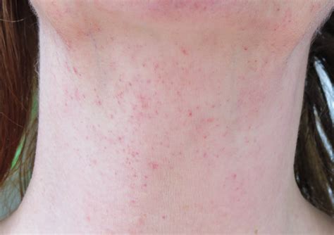 Petequias Causas Y Remedios Naturales