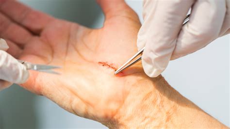 How To Break Up Scar Tissue After Carpal Tunnel Surgery The Nerve