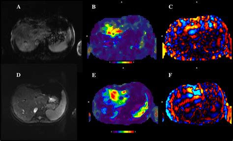 Magnetic Resonance Elastography Se Epi Vs Gre Sequences At 3t In A Pediatric Population With