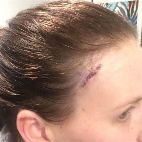 Skin Cancer Australia Melbourne Woman Saras Hairdresser Noticed Some