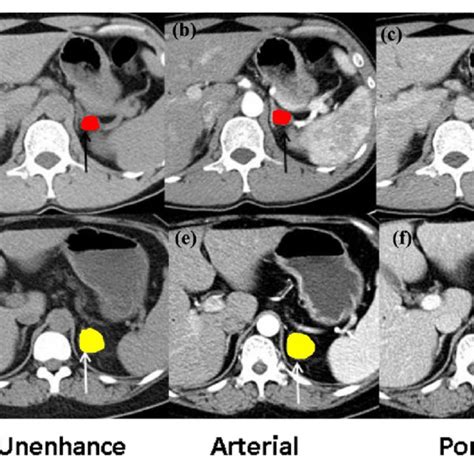 The Illustration Of Roi Selection A The Unenhanced And