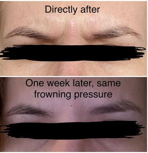 First Time With Botox R Plasticsurgery