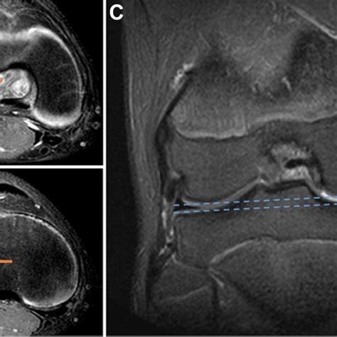Synthetic Polymer Meniscal Implant Nusurface Meniscus Implant Active Download Scientific