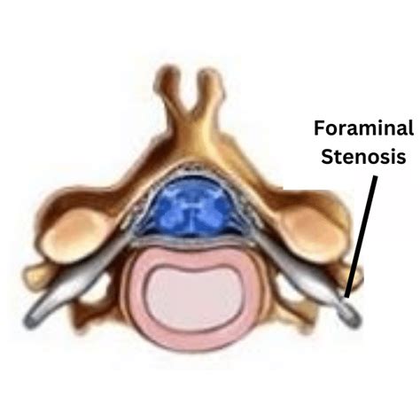 Cervical Spinal Stenosis Treatment Without Neck Surgery