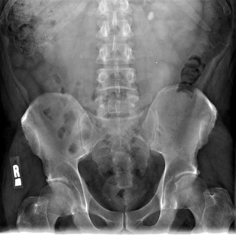 X Ray Artifacts