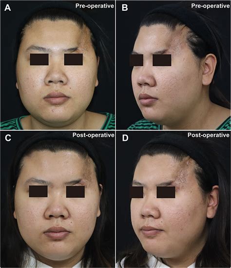 Bony Hyperplasia Beneath Atrophic Soft Tissue Ccid