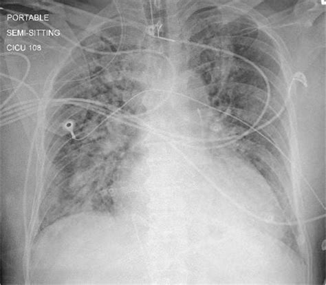 Chest X‐ray Bilateral Accentuation Of Lung Reticulation And