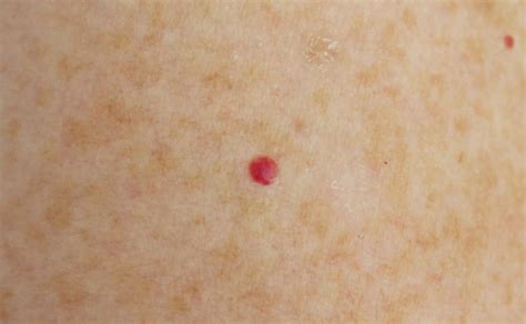 Cherry Angioma Removal Skin Surgery Clinic
