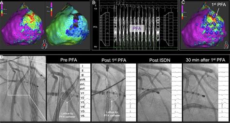 Pulsed Field Epicardial Ablation For Vt Storm A Case Report Of Bail