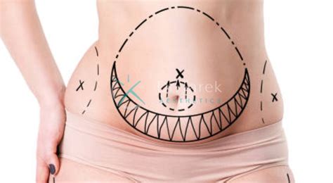 Flank Liposuction Overview Sculpt Your Waist 2026