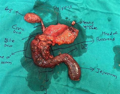Partial Whipple Procedure Pancreatic Cancer Surgery Past Present