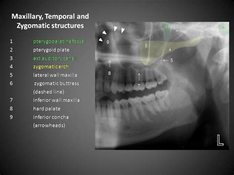 Zygoma Radiograph