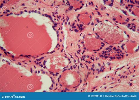 Cells Of A Human Thyroid Gland With Swelling Under A Microscope Stock Image Image Of Stain