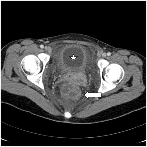 Ct Scan Of The Pelvis Showing A Thick Walled Urinary Bladder White Download Scientific Diagram