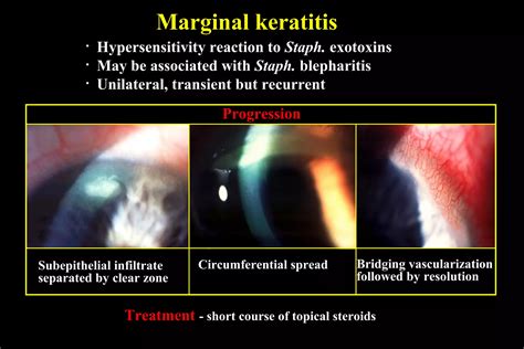 13 Peripheral Corneal Inflam Ppt