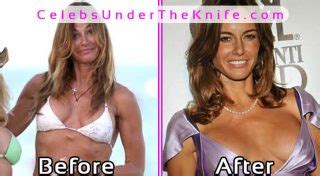 9 Bad Breast Implants Gone Wrong Before And After Photos