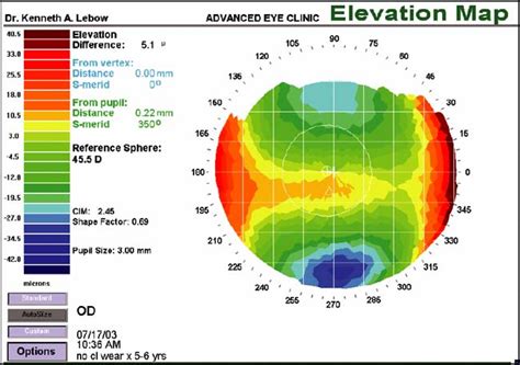 A Map To Contact Lens Wear Success Optometric Management
