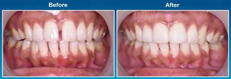 Midline Diastema Correction Sujays Dental Care