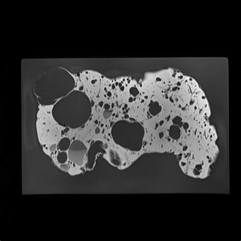 Radiopath Hepatobiliary System And Pancreas Nus Pathweb Nus Pathweb