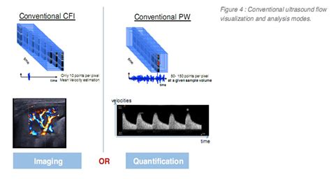 BÀi SoẠn VỀ SiÊu Âm ChẨn ĐoÁn Ultrafast Doppler Kết Hợp Pulsed Wave