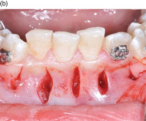3 Corticotomy Facilitated Orthodontics Pocket Dentistry