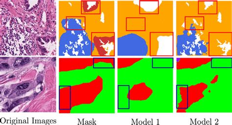 The Challenges Of Tumor Tissue Segmentation In Pathological Images