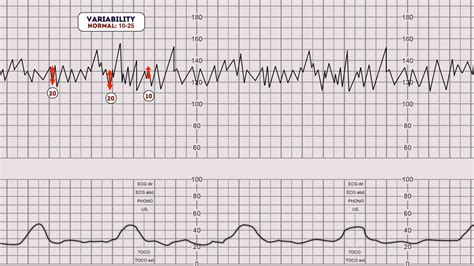 ΚΑΡΔΙΟΤΟΚΟΓΡΑΦΗΜΑ ΣΤΗΝ ΚΥΗΣΗ Μαρινάκης Α Ιωάννης Μαιευτήρας