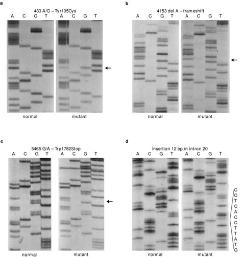 Sequencing Results For Brca1 Mutations A Missense Mutation In Case