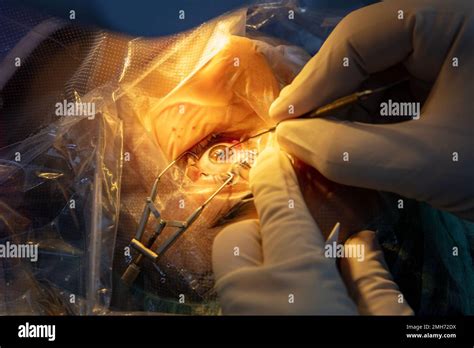 Eye Surgery Process Treatment Of Cataract And Diopter Correction