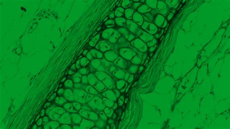 Transcript Demyelination And Axonal Damage In Cidp Medthority