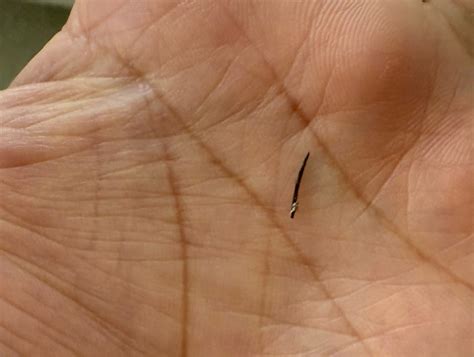 The Splinter Came Out After A Month By Dr Seema Patel Phd Never