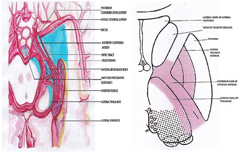Anterior Choroidal Artery Infarction Bmj Case Reports