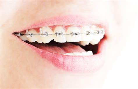 Straight Wire Braces For Straight Teeth Emergency Dentist San Jose Ca