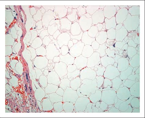 Figure 1 From Dedifferentiated Liposarcoma With Lipoma Like Well Differentiated Liposarcoma