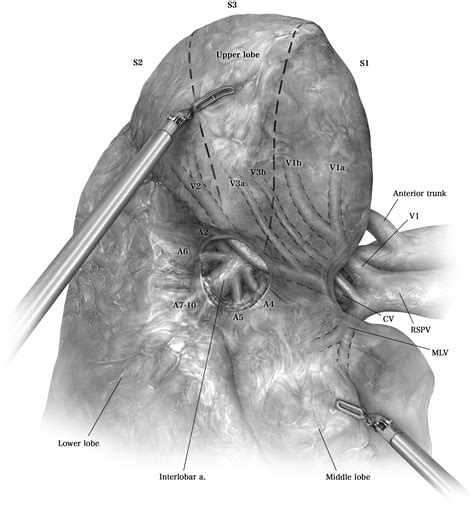 Minimally Invasive Complex Segmentectomies Of The Right Upper Lobe