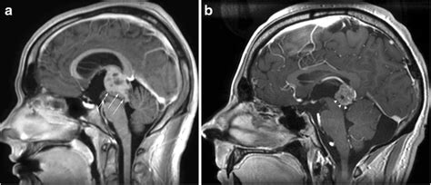 Midbrain Extension And Midbrain Compression A Sagittal Post Contrast Download Scientific