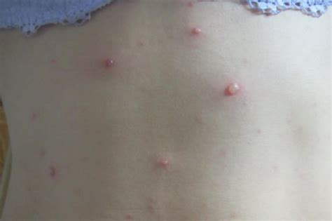 水痘图片与症状图片大全 百度健康·医学科普