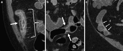 Ct Enterography Abdominal Key