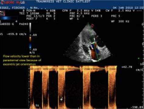 Subaortic Stenosis Case Members