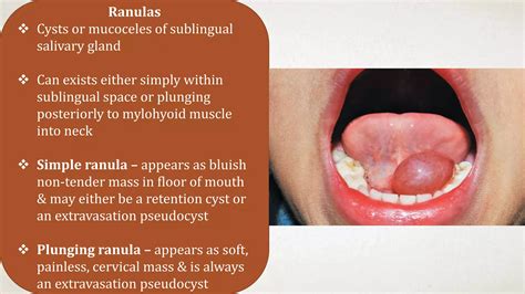 Surgical Anatomy Of Major Salivary Glands Pptx